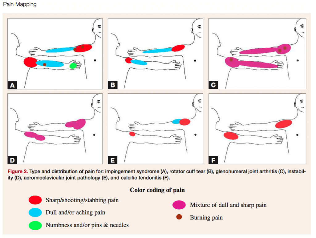 Shoulder Pain Referral Patterns are Reported in This Study